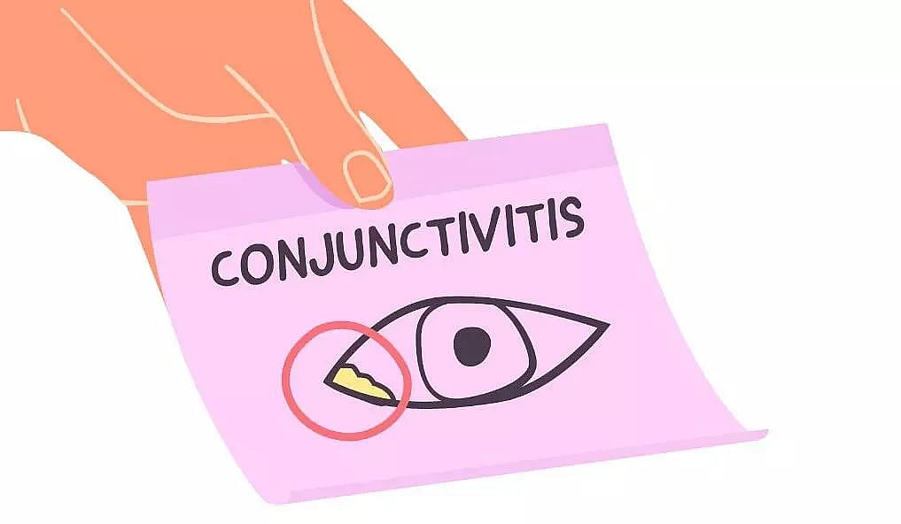 Conjunctivitis: Prevention and care