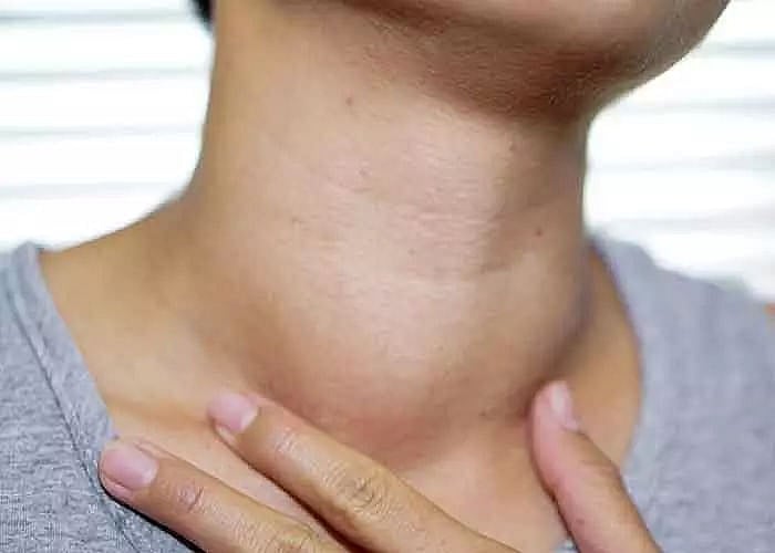 Neck lumps can be dangerous if avoided, need for early diagnosis.: Doctors