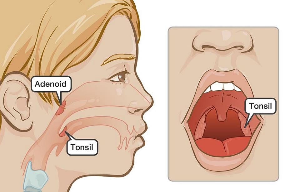 Tonsils and Adenoids: A Different Perspective