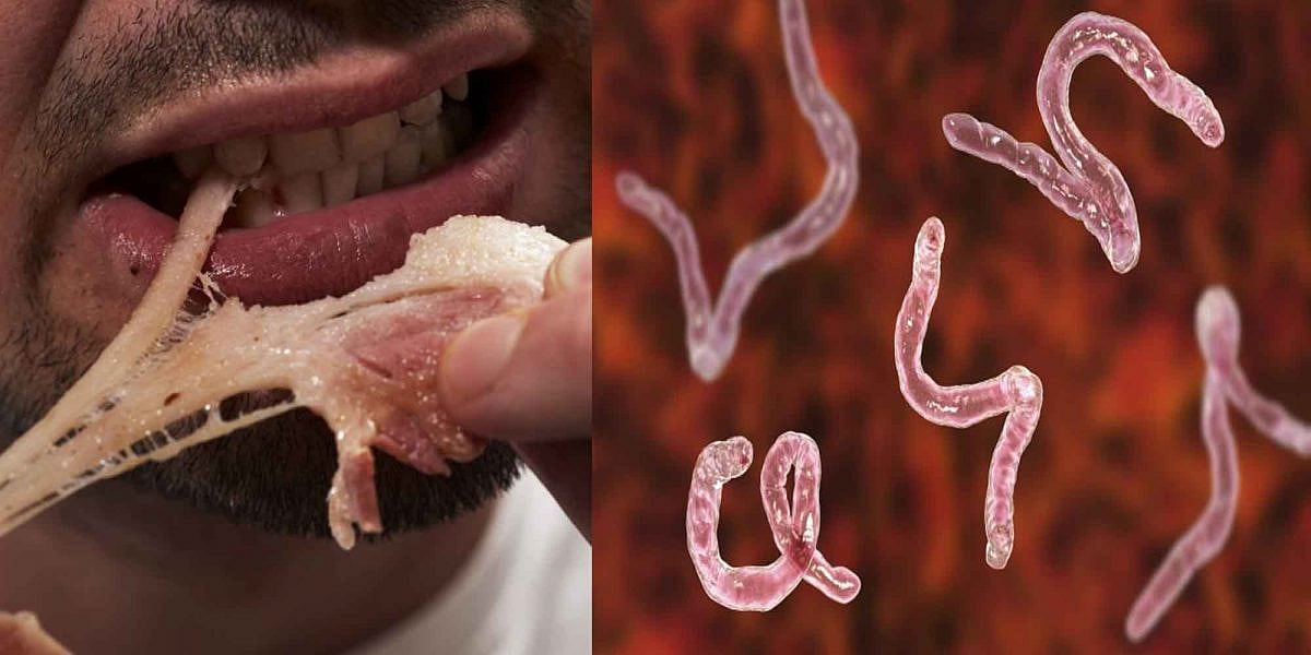 Man’s Brain, Chest Riddled with over 700 Worms after Eating Undercooked ...