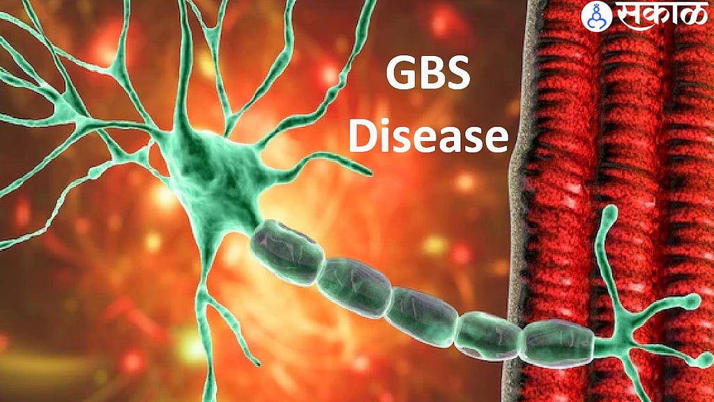 GBS patient : आसूत आढळला जीबीएसचा रुग्ण: परिसरात उडाली खळबळ ...