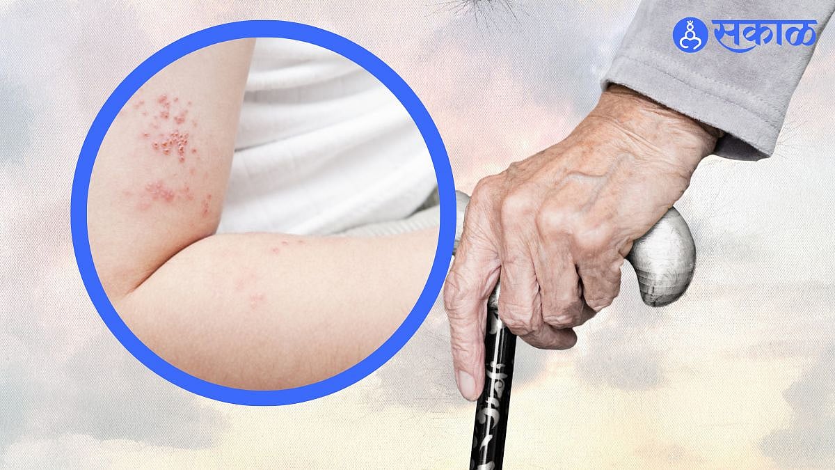 Shingles Rash : या वयोगटातील लोकांना नागीण आजाराचा धोका; लक्षणे जाणून ...