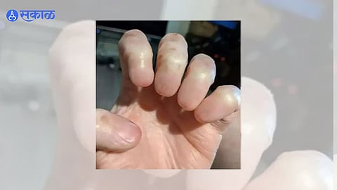 Anonychia Congenita : नखं नसलेला आजार; व्हायरल होणाऱ्या फोटोने ...