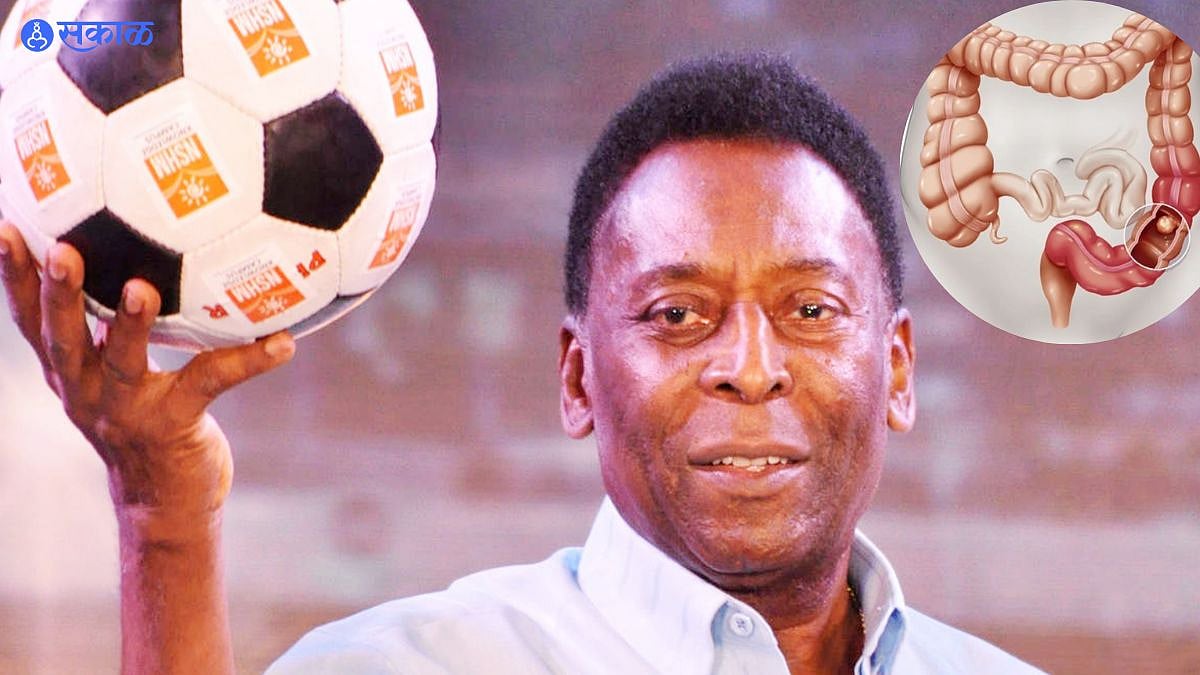 Pele Colorectal Cancer: दिग्गज फुटबॉलर पेलेंना झालाय कोलन कॅन्सर! या ...