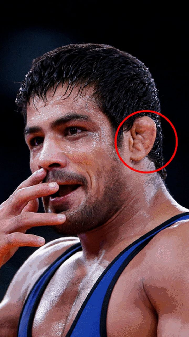Wrestler Ear : पैलवानांचे कान सुपारी घालून फोडतात का?