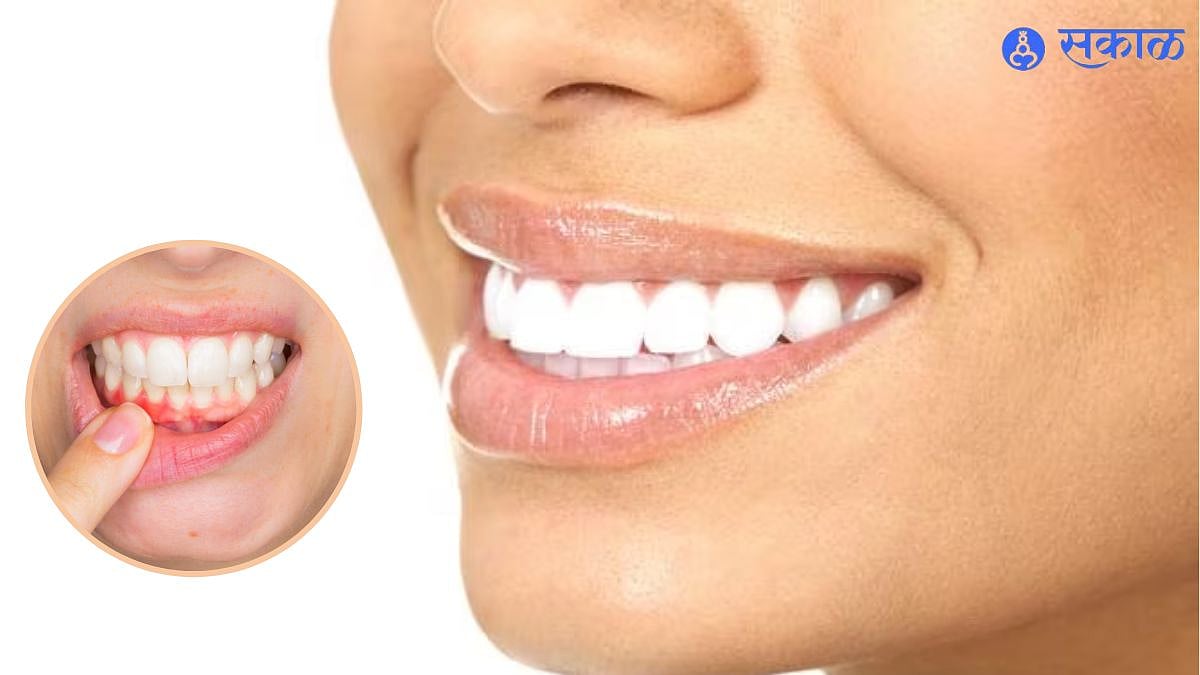 Pyria Home Remedies : दातांतून सतत रक्त येणं, वास येणं घाणं वाटतं; ब्रश ...