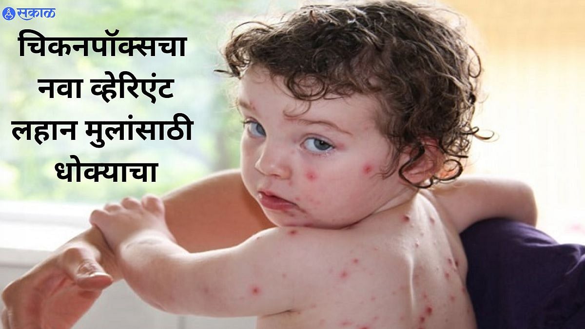 Chickenpox Clade 9 Symptoms : चिकन पॉक्सचा नवा व्हेरिएंट लहान मुलांना ...