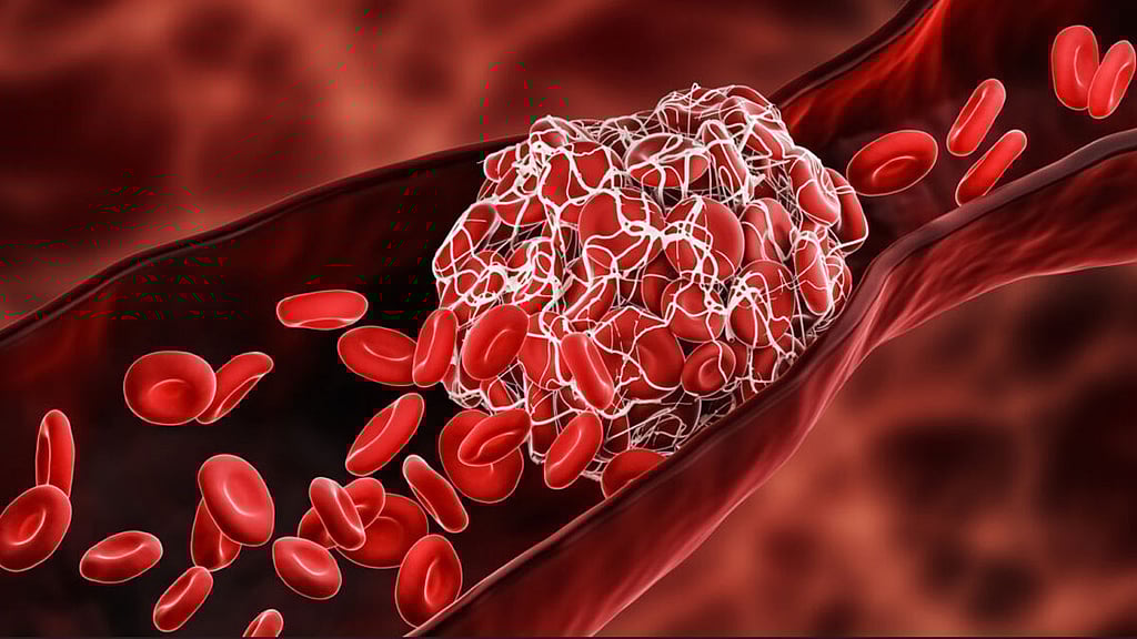 संवाद : गुठळ्या झालेल्या रक्तवाहिन्यांचे वेदनाशमन dr vijay ramanan ...