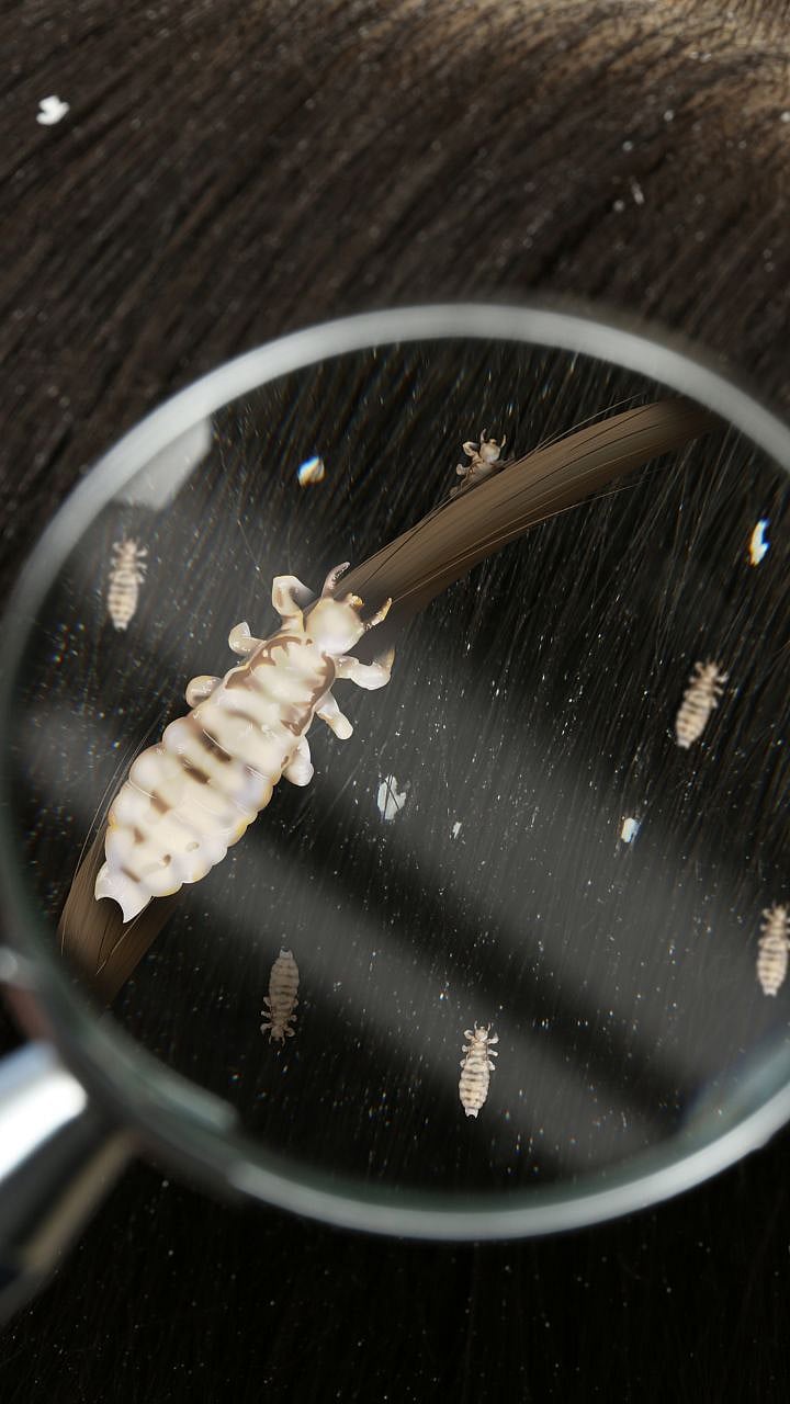 केसात उवा कशामुळे होतात? |how to get rid of lice and take care of your ...