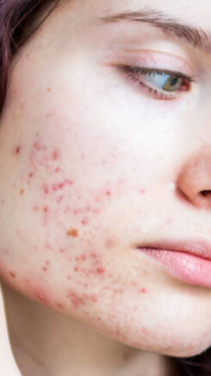 पिंपल्स आणि रींकल्सपासून त्रस्त आहात मग हे उपाय करून एकदा पाहाच