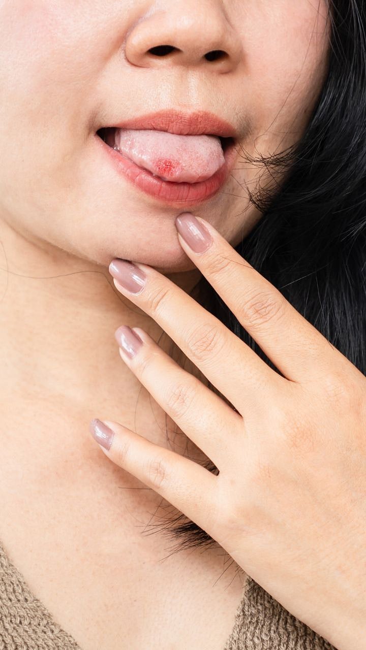 Mouth Ulcer Care: Effective Tips for Prevention and Relief | सारख तोंड ...