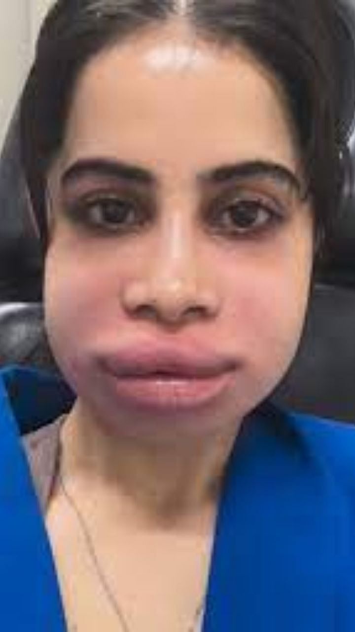 Lip Filler Risks: Top Disadvantages and Side Effects to Know | Esakal ...