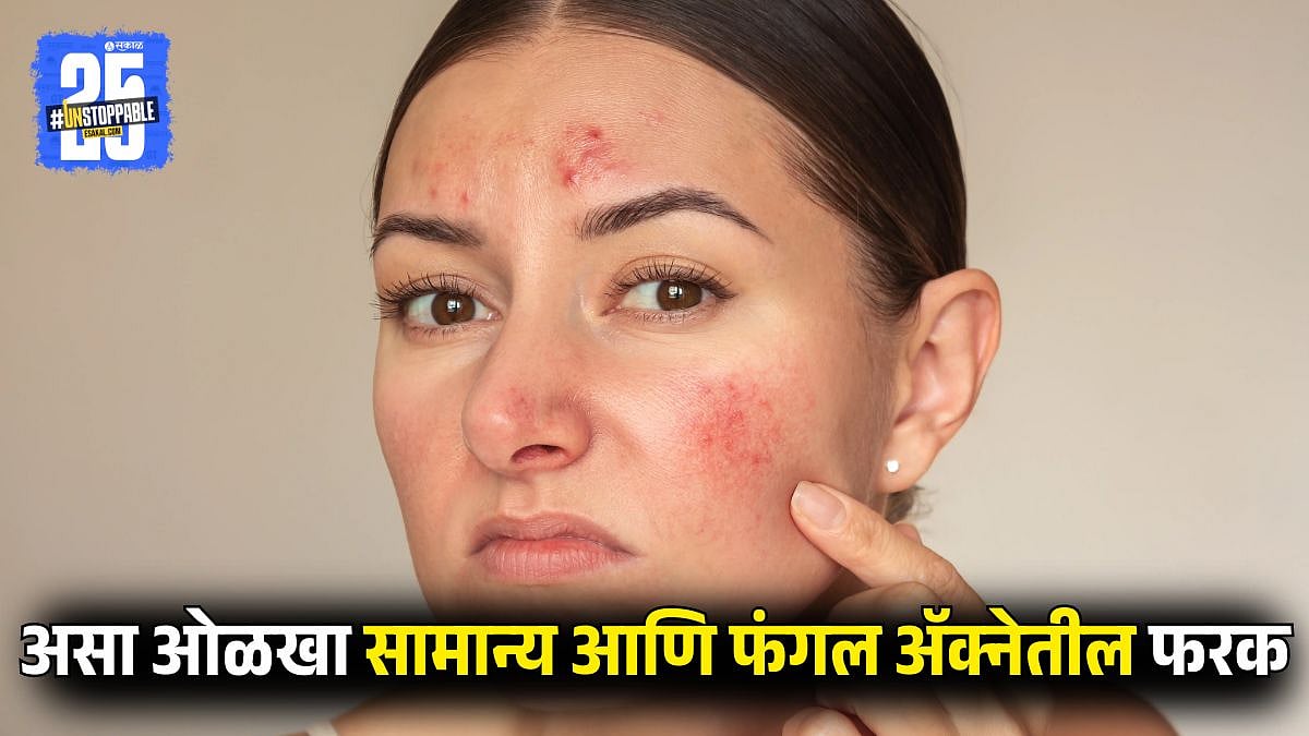 Itchy Pimples or Fungal Acne: पिंपल्सना सतत खाज सुटतेय? हे मुरूम नसून ...