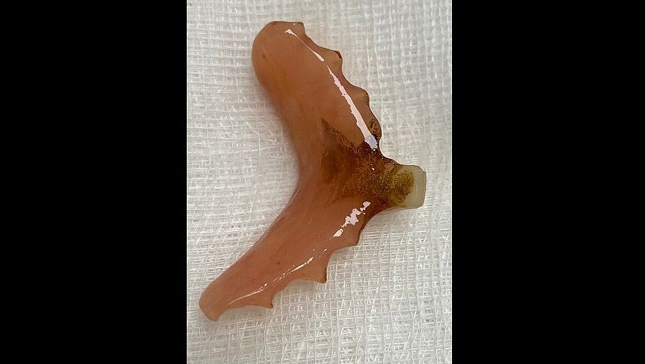 Panvel: Elderly man swallows denture, doctors remove it without surgery