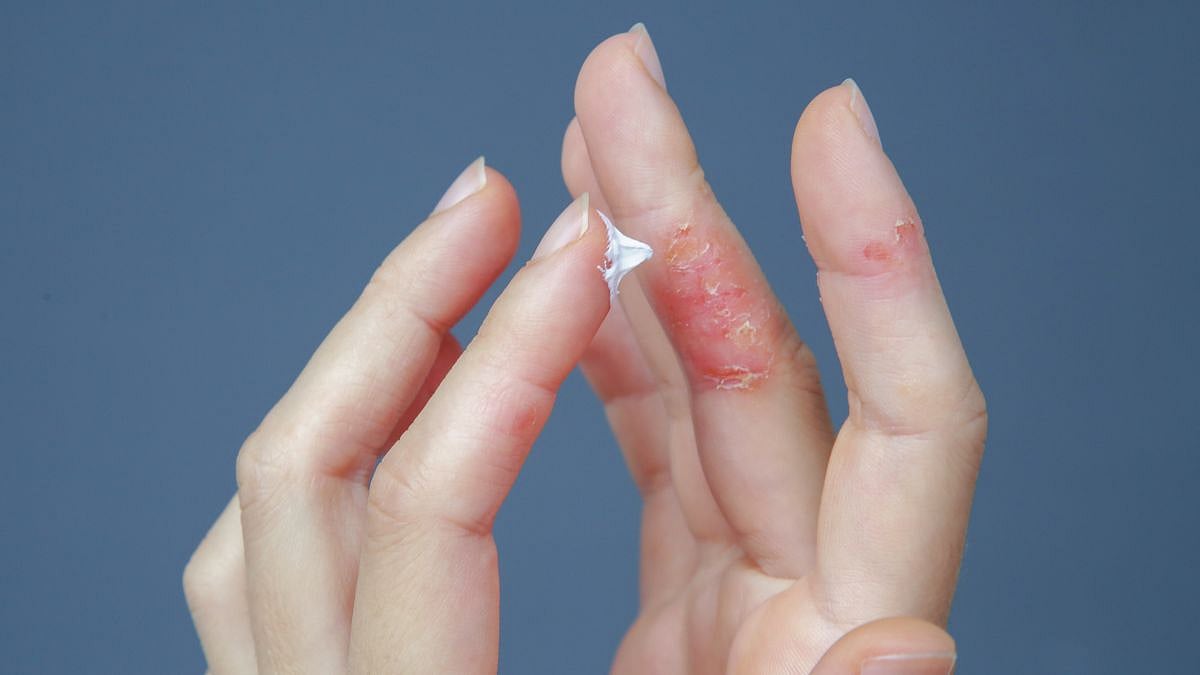 Atopic Dermatitis: Using Ceramide-Based Skincare Products? Here's What ...
