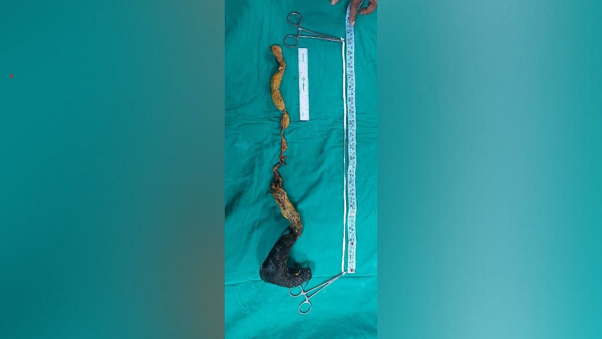 Mumbai: Doctors Remove 50 cm Hairball From 10-Year-Old Girl's Stomach ...