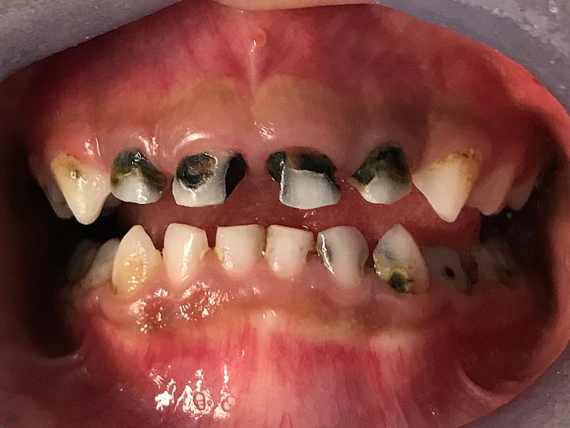 Tooth Decay In Baby Teeth Kellogg Latz Dentistry