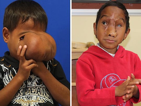 Huge growth on Filipino boy’s face removed by Australian surgeons
