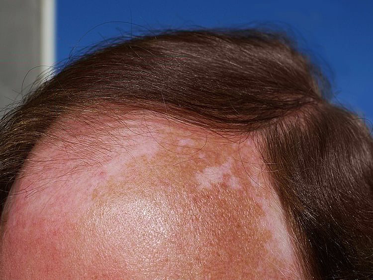 What Causes White Spots On Face - Infoupdate.org