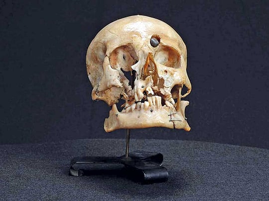 The Anzac skull that tells a shocking and tragic story of battlefield ...