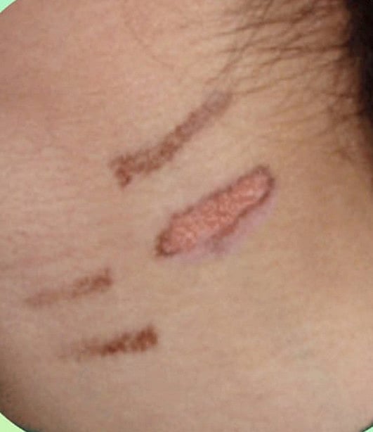 Laser Hair Removal Burns Laser Hair Removal Can Cause First Degree