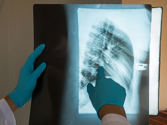 New treatment in UAE for COPD lung ailment offers hope