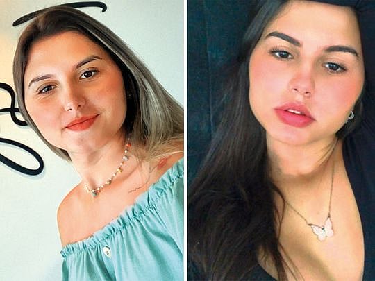 Brazil trans twins undergo gender confirmation surgery together