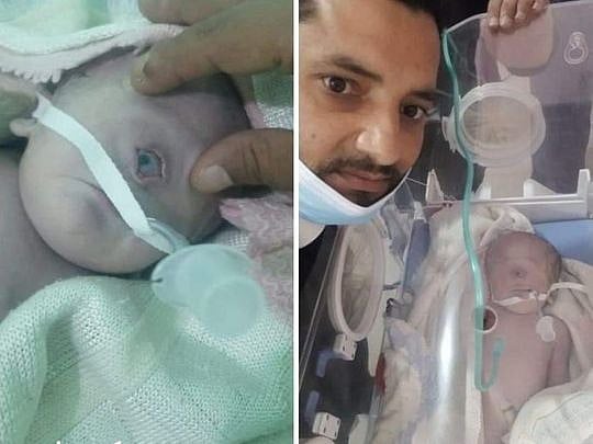 One-eyed baby born in Yemen dies 7 hours later