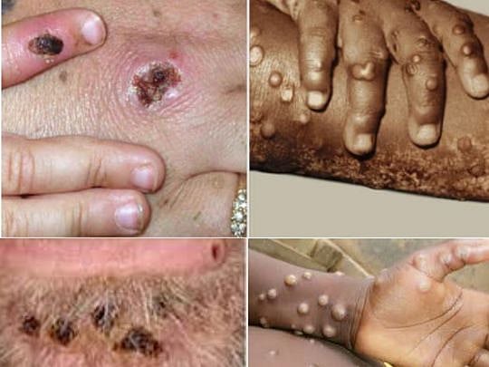 Monkeypox risk higher in children 8 or younger: research
