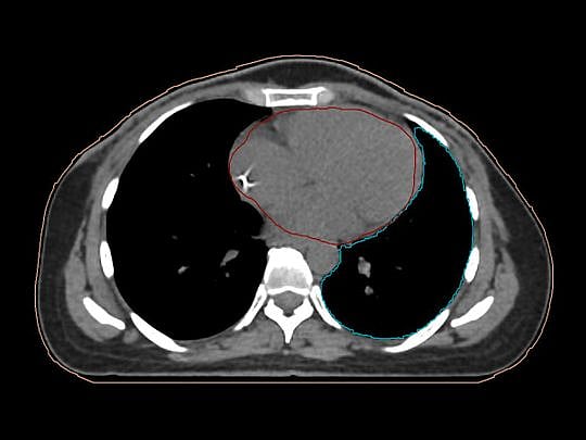 ACOC: Radiotherapy plays a major role in the management of breast cancer