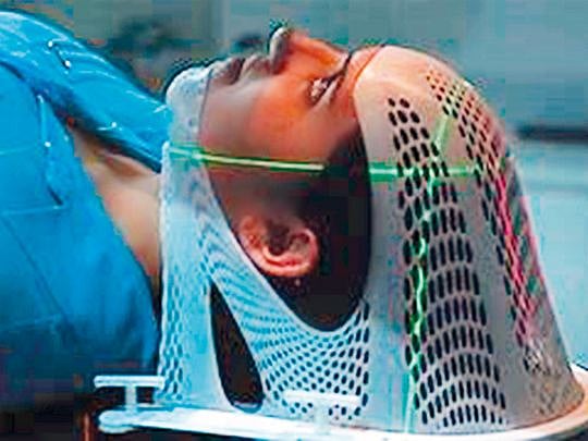 ACOC: Stereotactic radiosurgery for Benign Intracranial Tumors