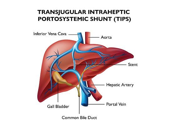 First-ever TIPS procedure performed at King’s College Hospital London ...