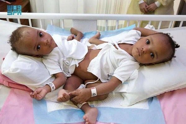 Saudi Arabia: Conjoined twins successfully separated after 14-hour ...