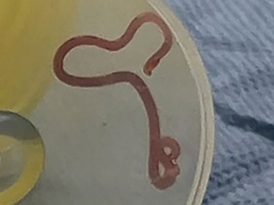 Australian doctors find live parasitic worm in woman's brain
