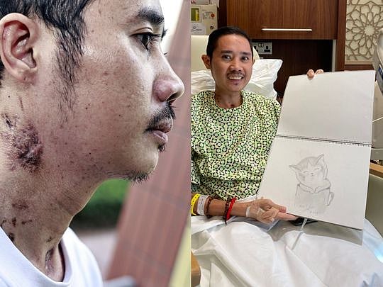 Double lung transplant: Filipino expat, 37, grateful to UAE for new ...