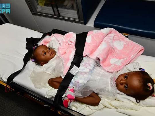 Saudi medical team successfully separates Nigerian conjoined twins ...