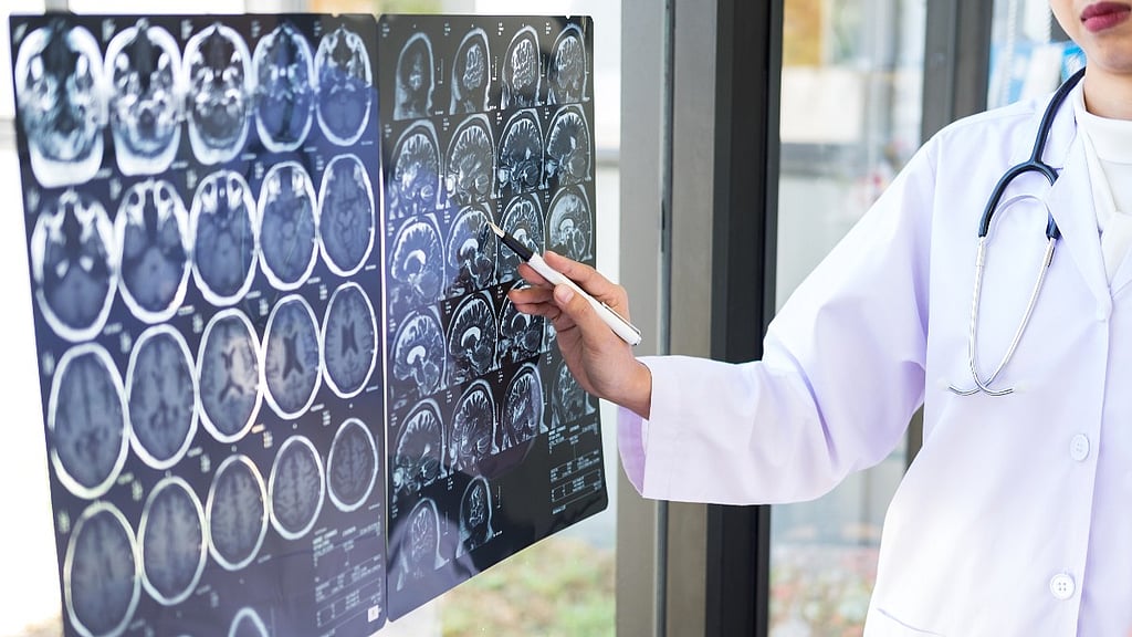 Understanding Stroke: Types, Symptoms, Causes and Treatments