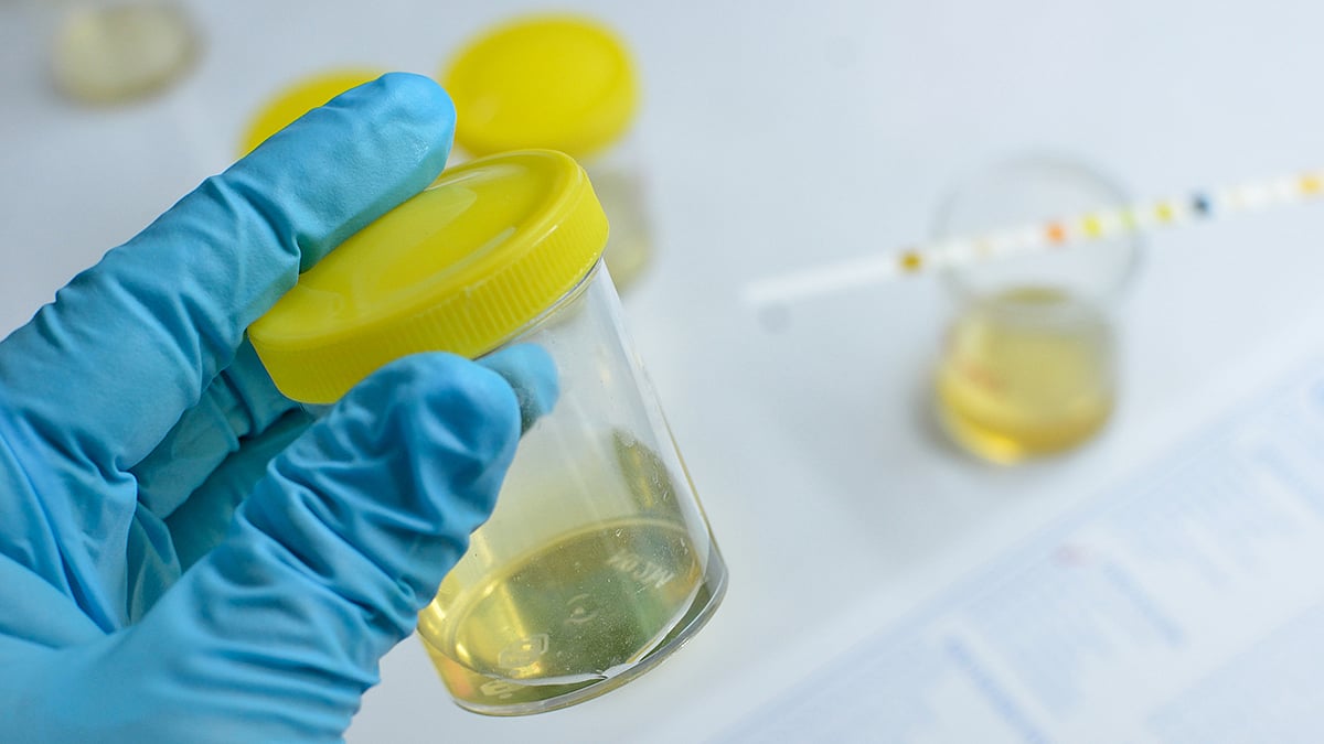 Urine Test Shows Promise in the Early Detection of Cervical Cancer