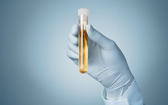 Urine-Based Test Accurate Testing Option for Advanced Prostate Cancer