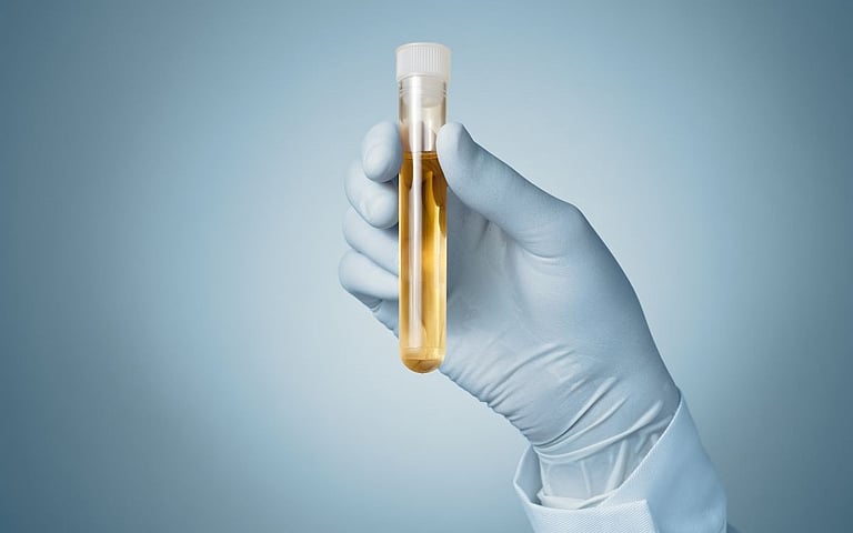 Urine-Based Test Accurate Testing Option for Advanced Prostate Cancer