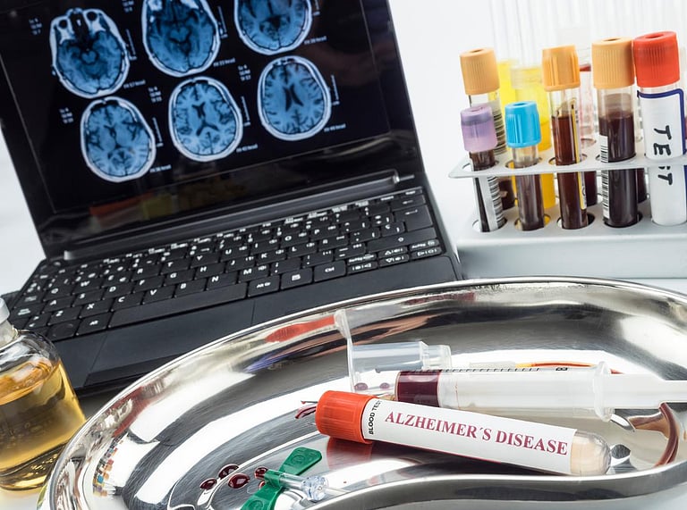 Lecanemab: Study Finds Alzheimer’s Drug Safe in Memory Clinics