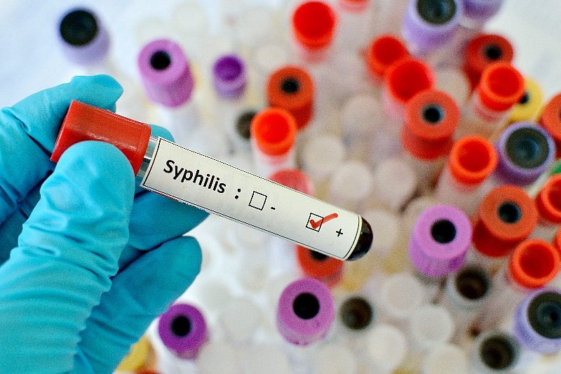 U.S. Syphilis Cases Continue to Rise