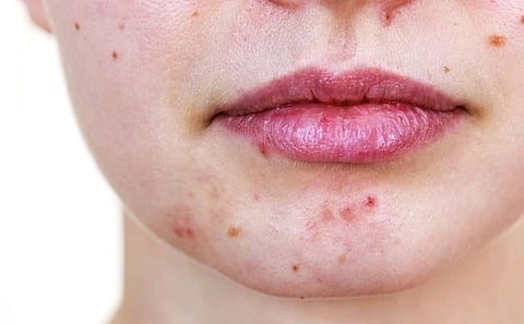 AAD Updates Guidelines for Management of Acne Vulgaris