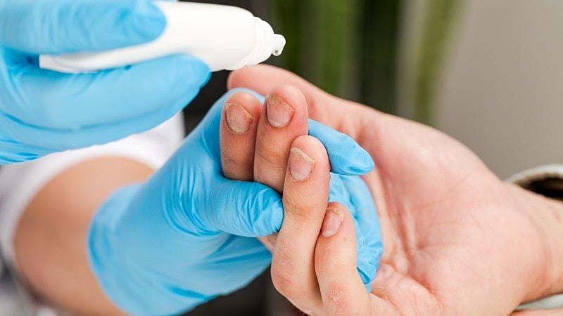 Individuals With BAP1 Have High Rate of Nail Abnormalities