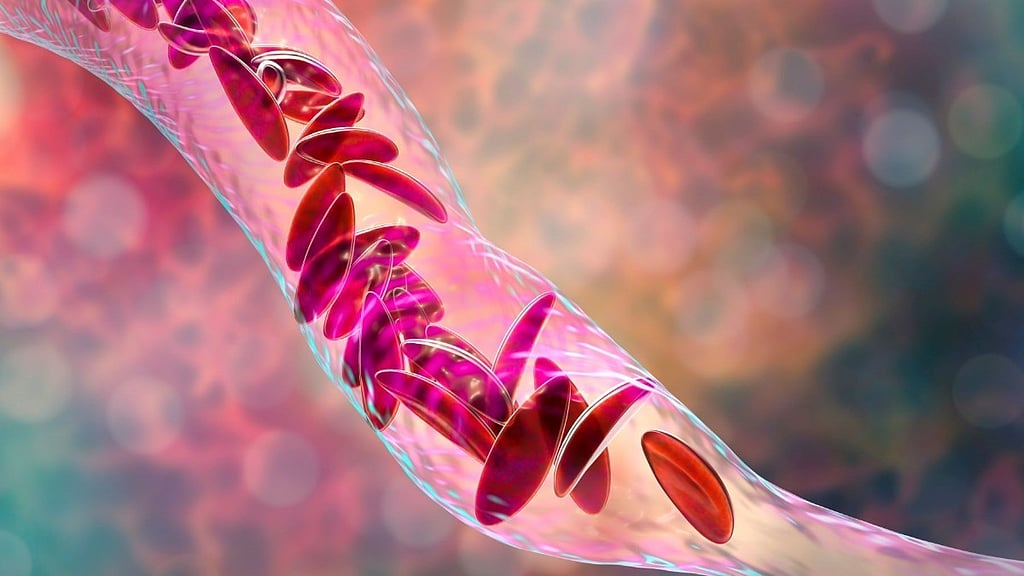 Sickle Cell Disease Linked to Premature Brain Aging, Study Finds