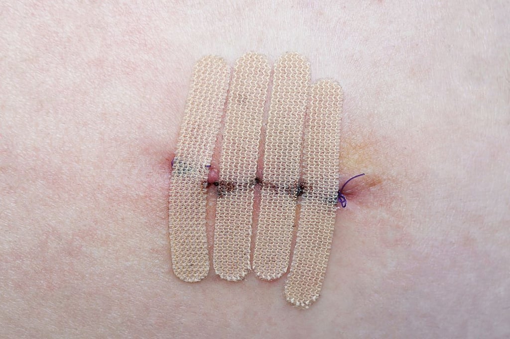 Extra Lesions ID'd During Mohs Visits Are Often Nonmelanoma Skin Cancer