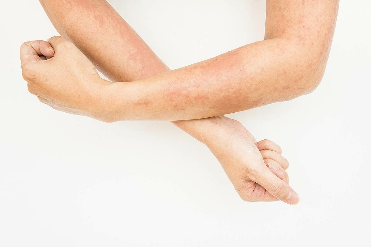 Staged Approach Suggested for Patient-Decision Aid in Eczema