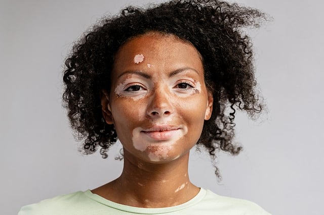 Total, Facial Vitiligo Area Scoring Indices Effectively Differentiate ...
