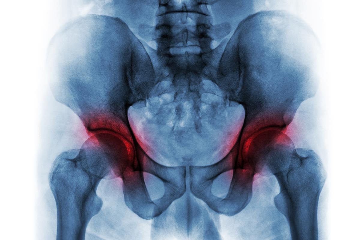 Hip Replacement Surgery: What It Is, Benefits, Risks, Prep & Recovery