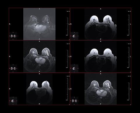 Mammograms May Also Reveal Hidden Heart Disease Risk, Study Finds